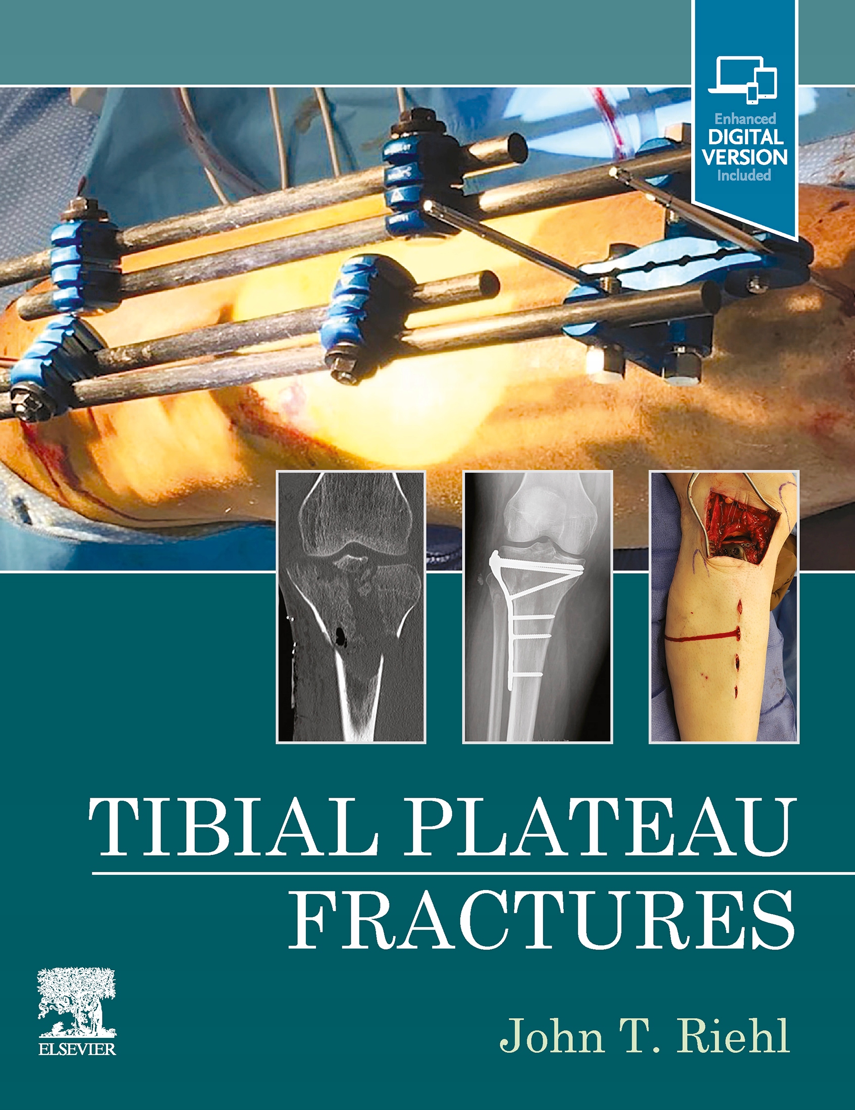 Tibial Plateau Fractures - Riehl, John (12604340191) | Ebook Allegro