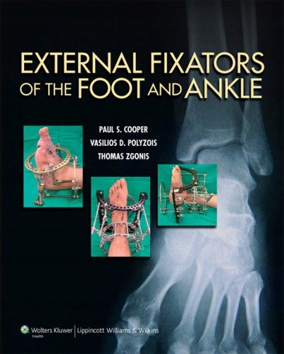 External Fixators of the Foot and Ankle Cooper (13876533774) | Książka ...