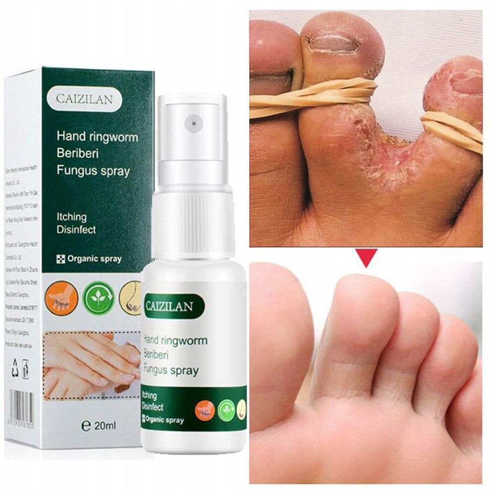 Anti Fungal Foot Spray Fungal Cream 13956967193 - Allegro.pl