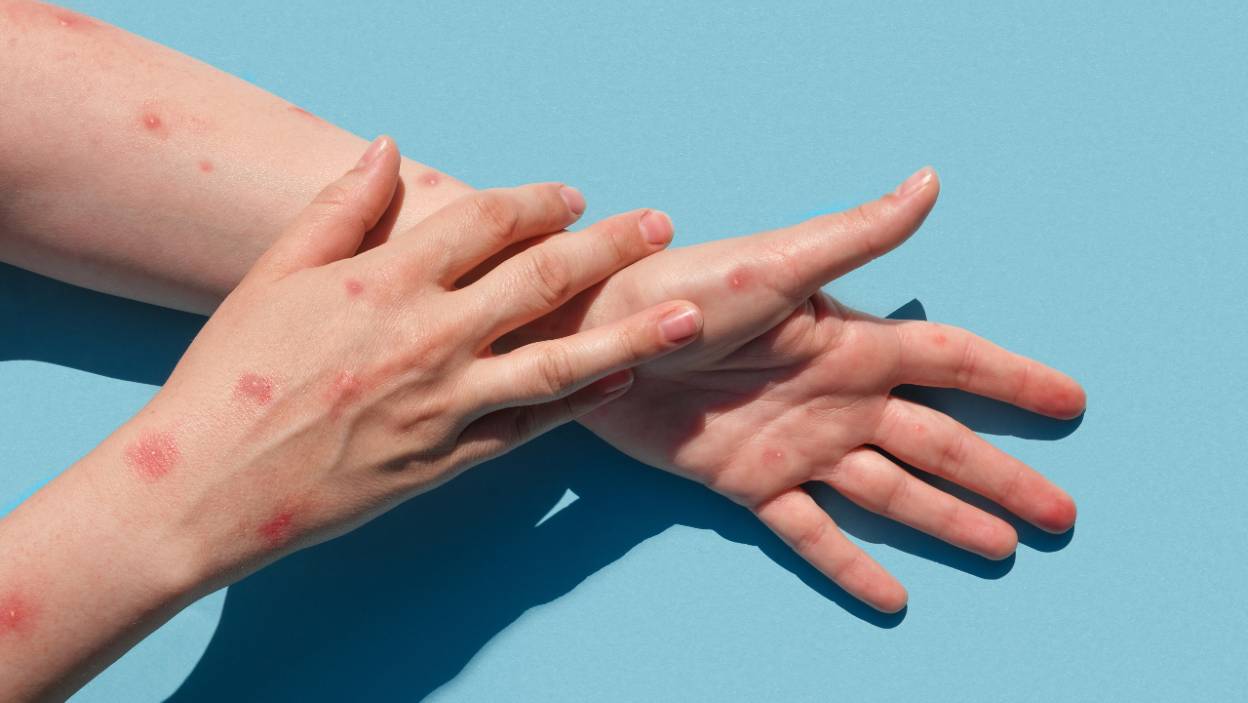 Czym jest małpia ospa? Poznaj przyczyny powstania i objawy tej choroby ...