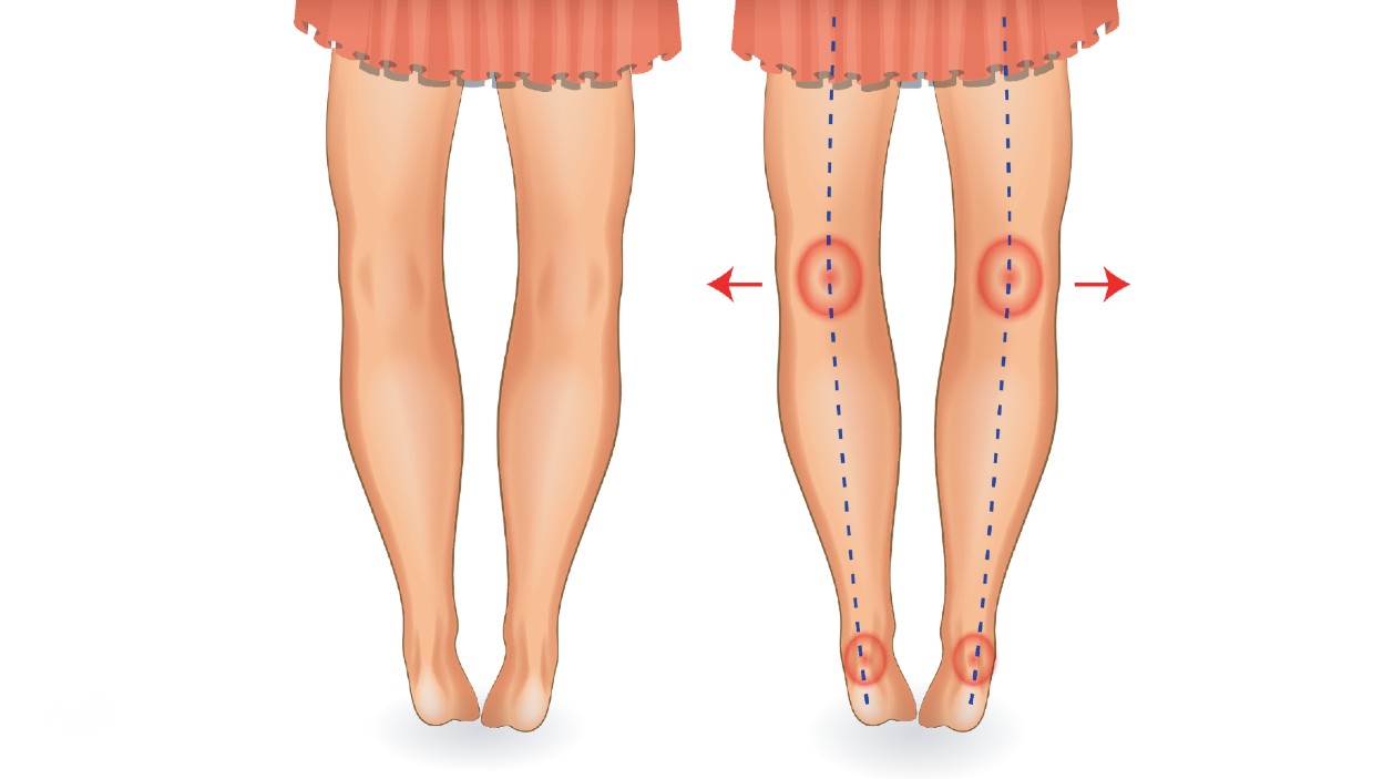 Kolana szpotawe – jak można ćwiczyć z dzieckiem w domu? - Allegro.pl
