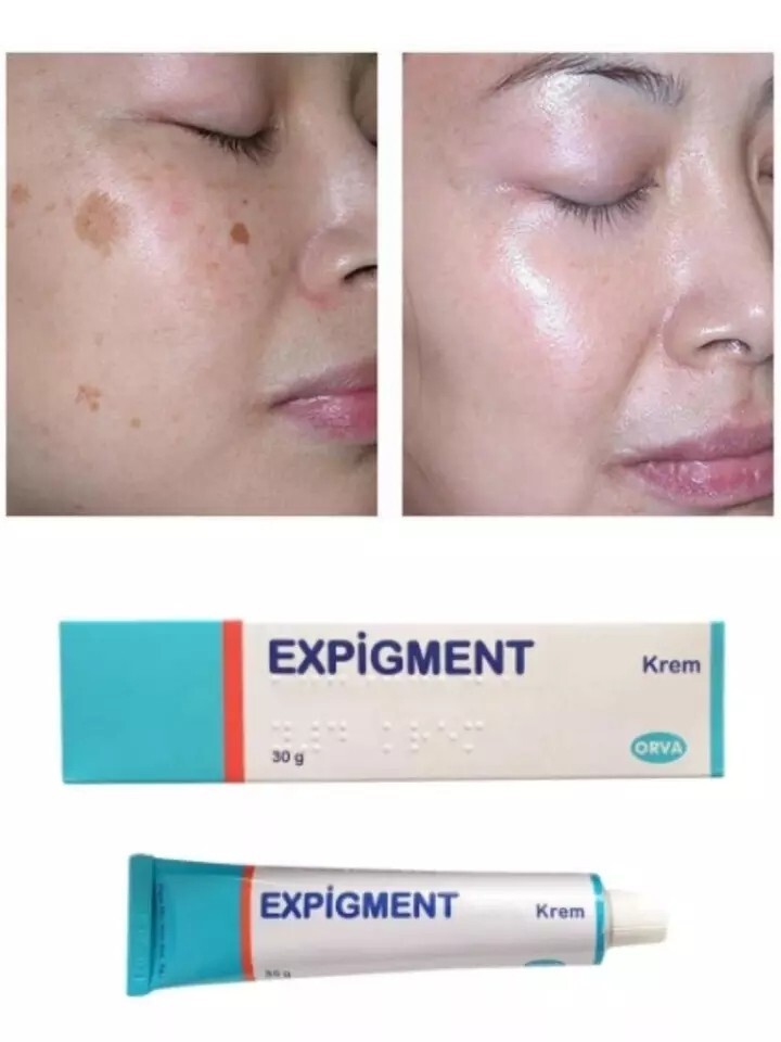 Expigment 4% Krem Wybielający na Przebarwienia 30G | Sandomierz | Kup ...