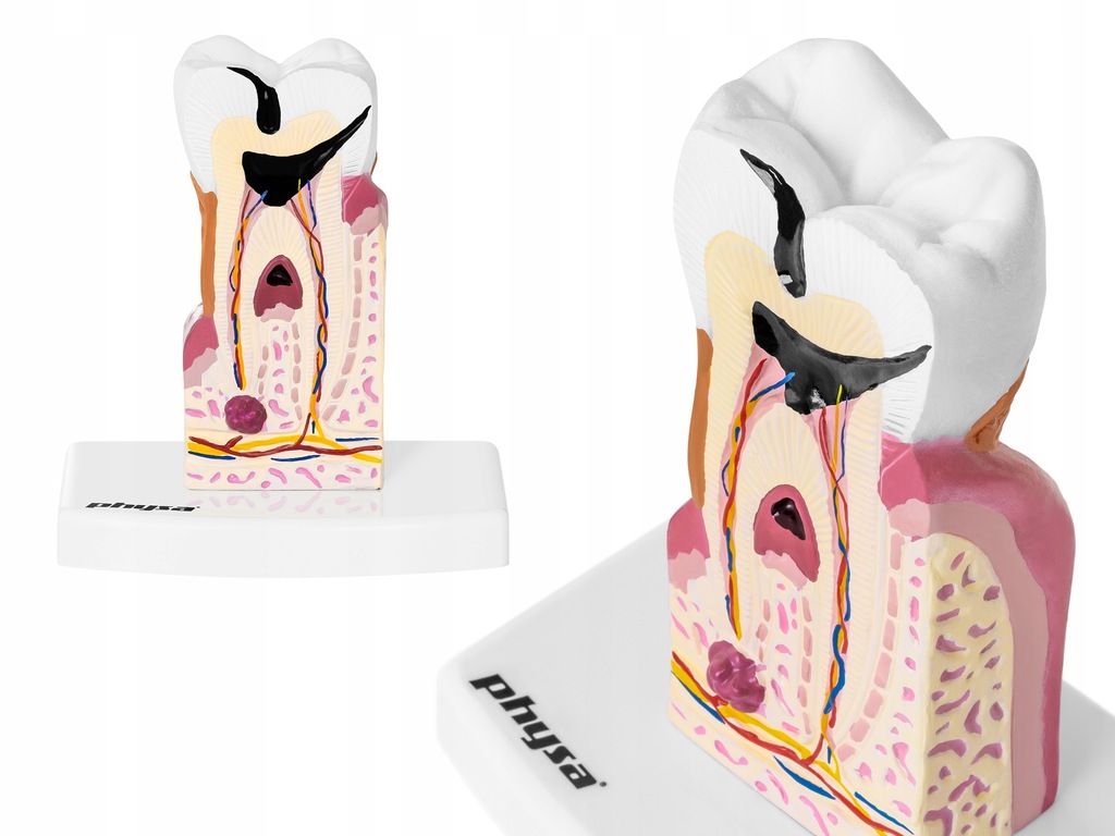 Купить Анатомическая модель больного зуба человека по шкале 6.: отзывы, фото и характеристики на ...