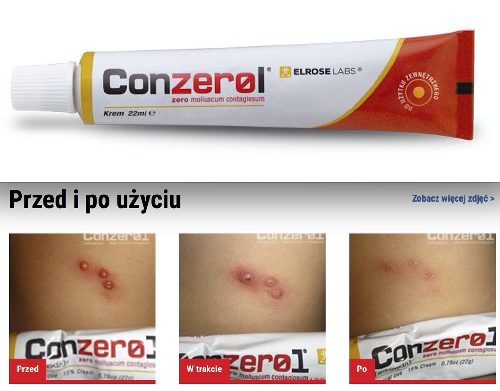 Conzerol - maść na mięczak zakaźny - 7004821184 - oficjalne archiwum ...