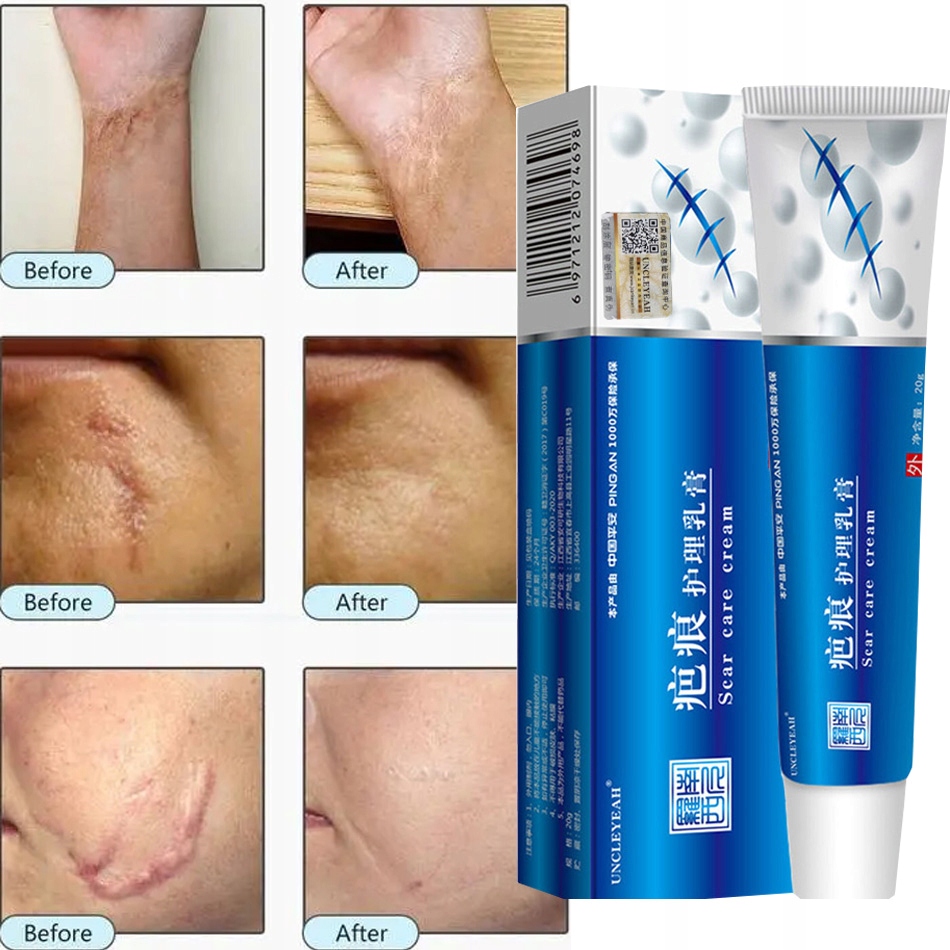 Acne Scar Removal Cream Pimples Stretch Marks - 14046908384 - oficjalne archiwum Allegro